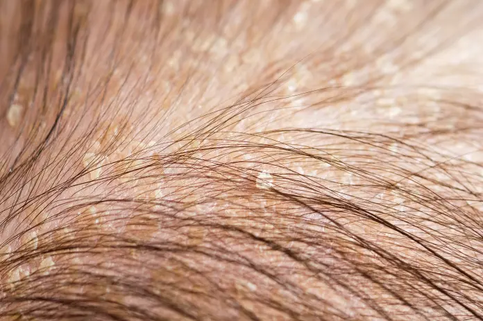 Dermite Séborrhéique : Symptômes et Traitements